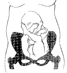 BREECH PRESENTATION - Radiology Made Easy